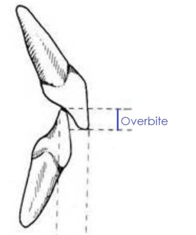 Let's Talk About Overbites - High Line Orthodontics