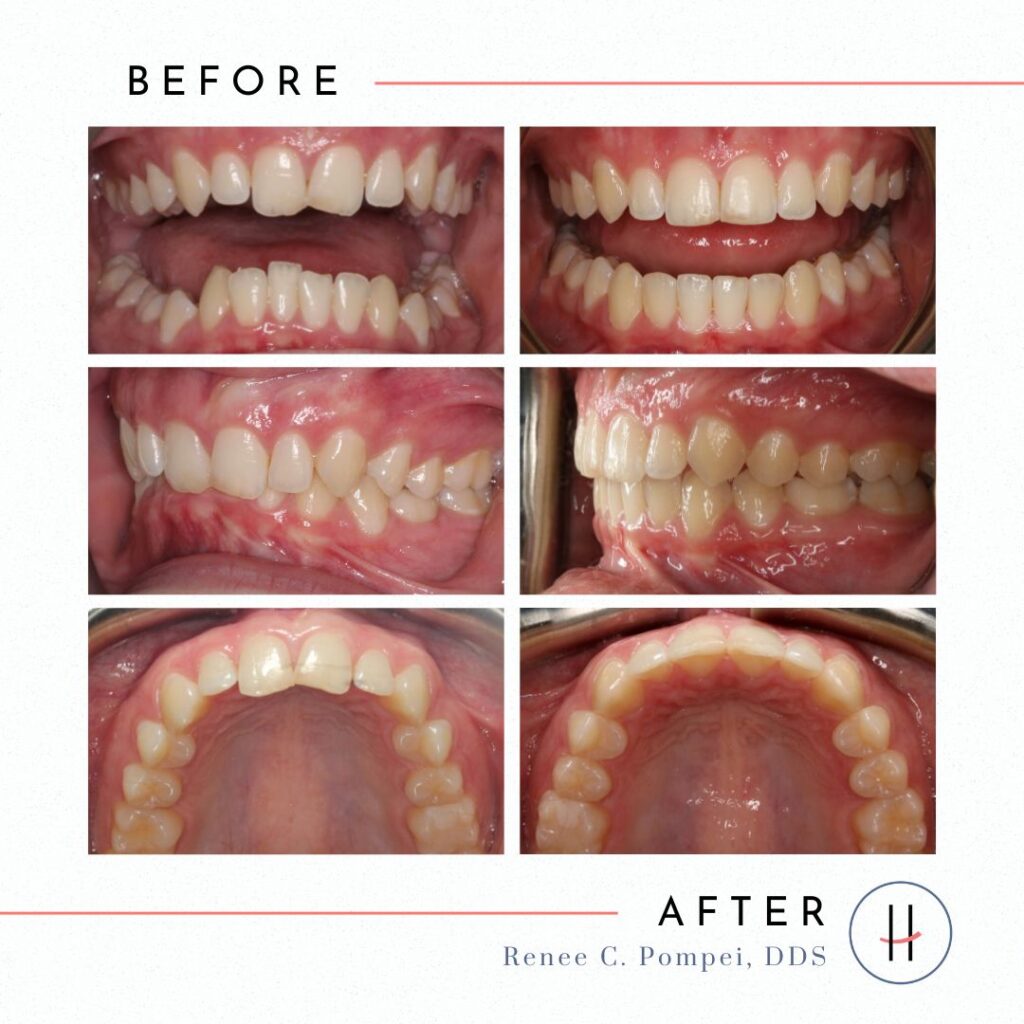 Let's Talk About Overbites - High Line Orthodontics