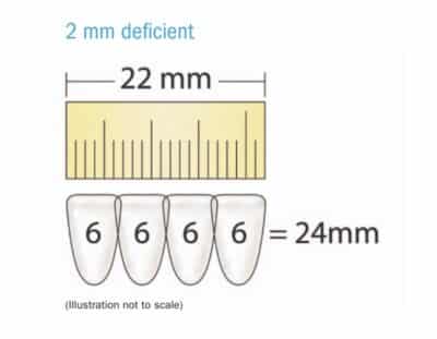 Interproximal Reduction (IPR) - High Line Orthodontics