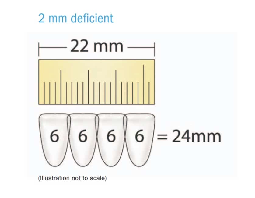 Interproximal Reduction (IPR) - High Line Orthodontics